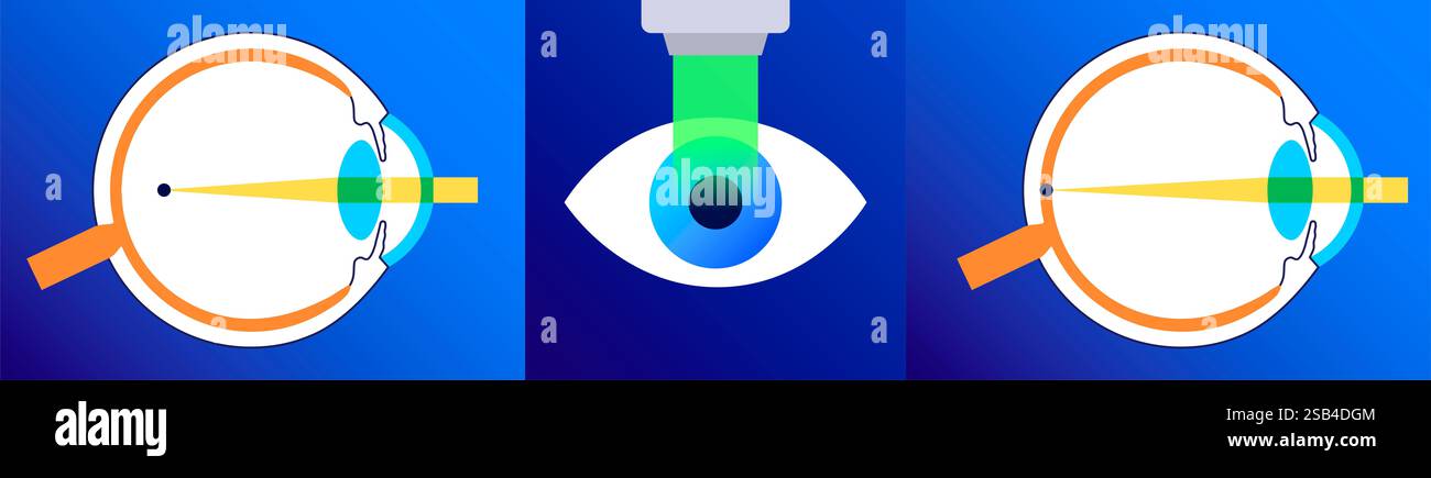Illustration of LASIK (Laser-Assisted In Situ Keratomileusis) also ...