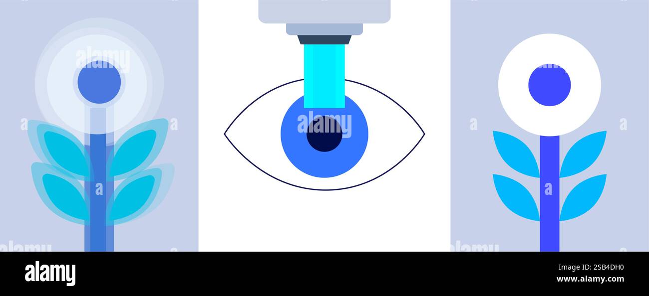 Illustration of LASIK (Laser-Assisted In Situ Keratomileusis) also ...