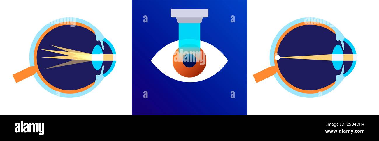 Illustration of LASIK (Laser-Assisted In Situ Keratomileusis) also ...