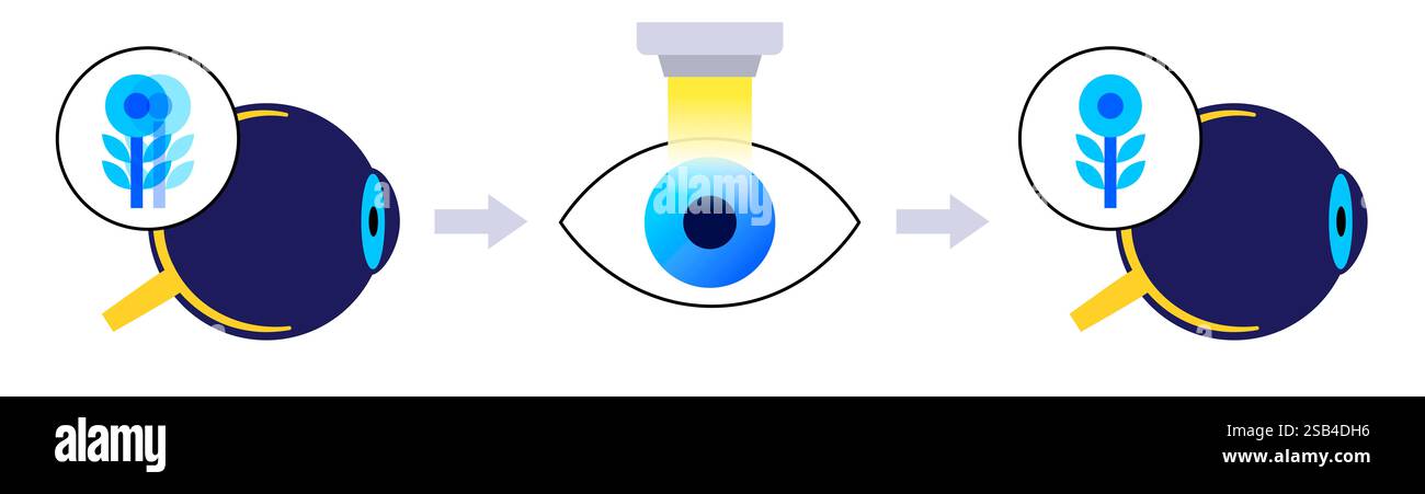 Illustration of LASIK (Laser-Assisted In Situ Keratomileusis) also ...