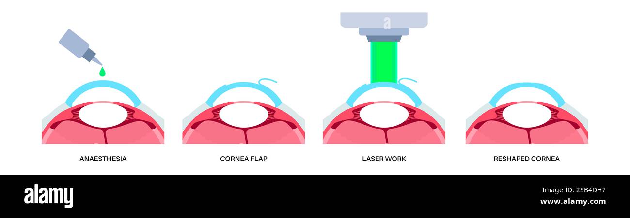 Illustration of LASIK (Laser-Assisted In Situ Keratomileusis) also ...