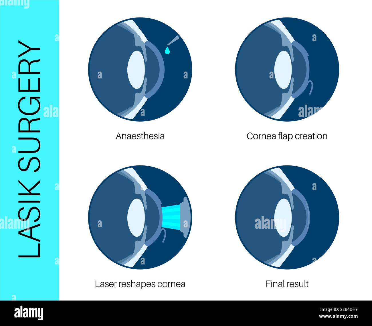 Illustration of LASIK (Laser-Assisted In Situ Keratomileusis) also ...