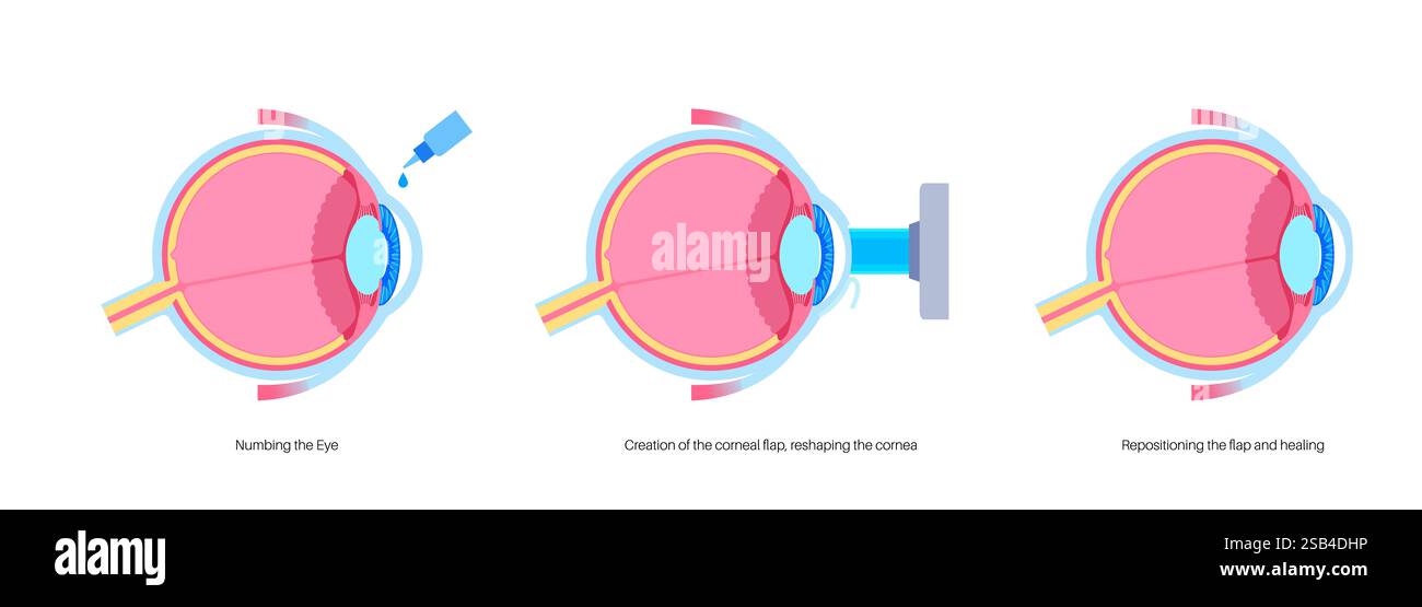 Illustration of LASIK (Laser-Assisted In Situ Keratomileusis) also ...