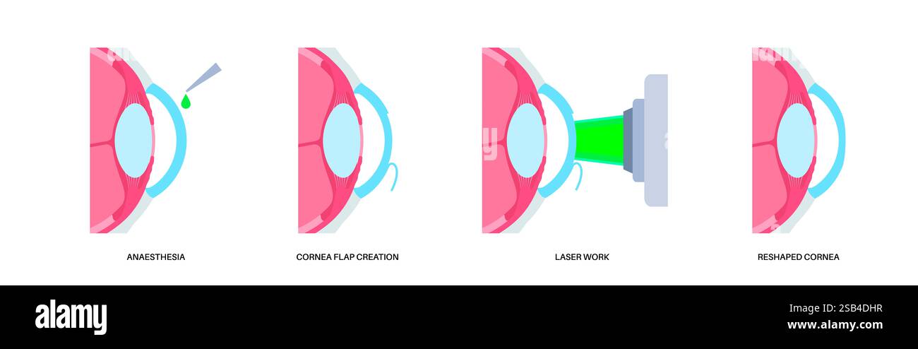 Illustration of LASIK (Laser-Assisted In Situ Keratomileusis) also ...