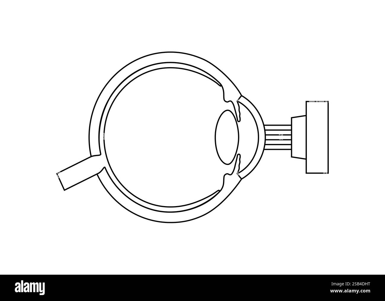 Illustration of LASIK (Laser-Assisted In Situ Keratomileusis) also ...