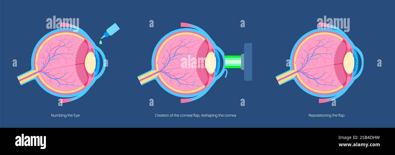Illustration of LASIK (Laser-Assisted In Situ Keratomileusis) also ...