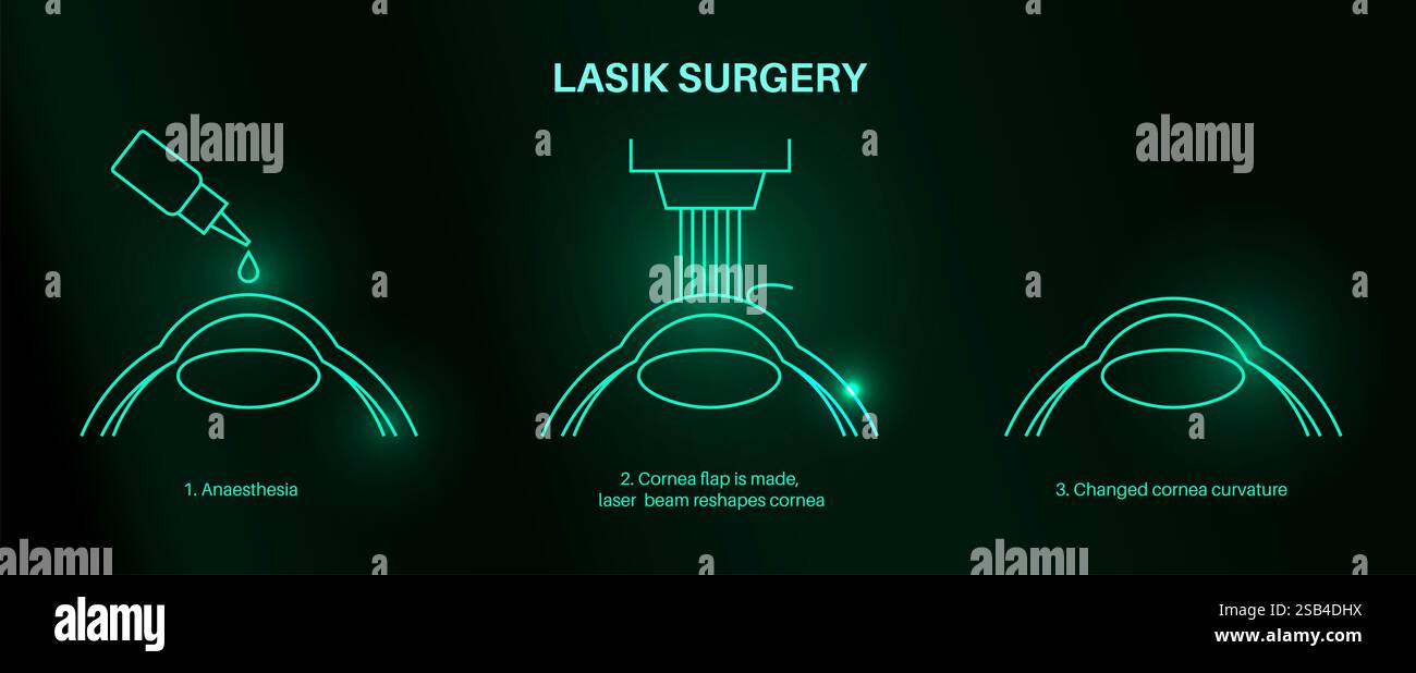 Illustration of LASIK (Laser-Assisted In Situ Keratomileusis) also ...