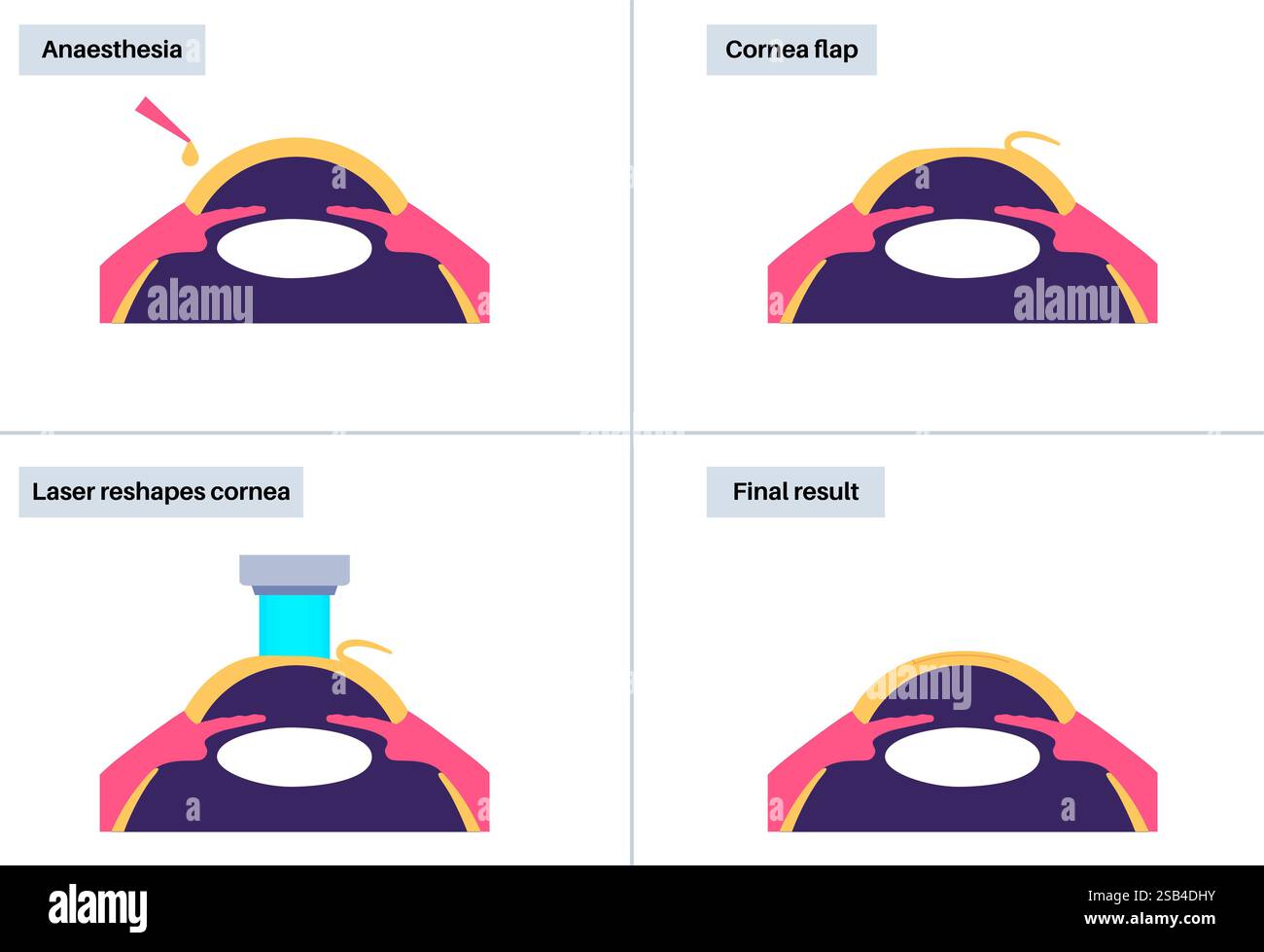 Illustration of LASIK (Laser-Assisted In Situ Keratomileusis) also ...