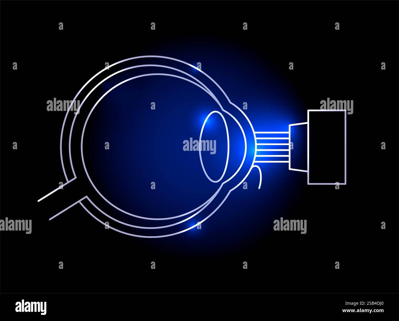 Illustration of LASIK (Laser-Assisted In Situ Keratomileusis) also ...