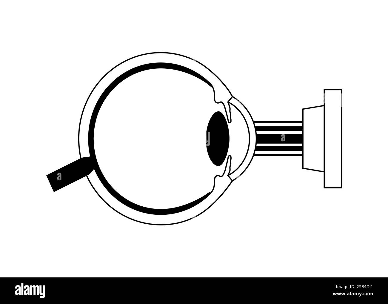 Illustration of LASIK (Laser-Assisted In Situ Keratomileusis) also ...