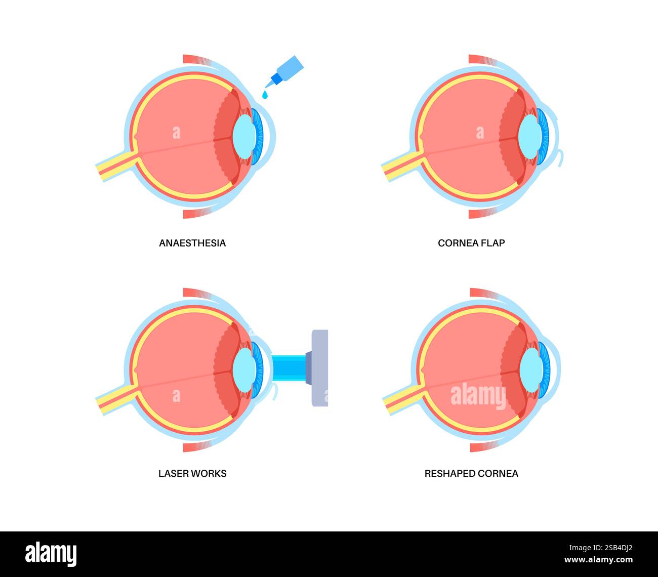 Illustration of LASIK (Laser-Assisted In Situ Keratomileusis) also ...