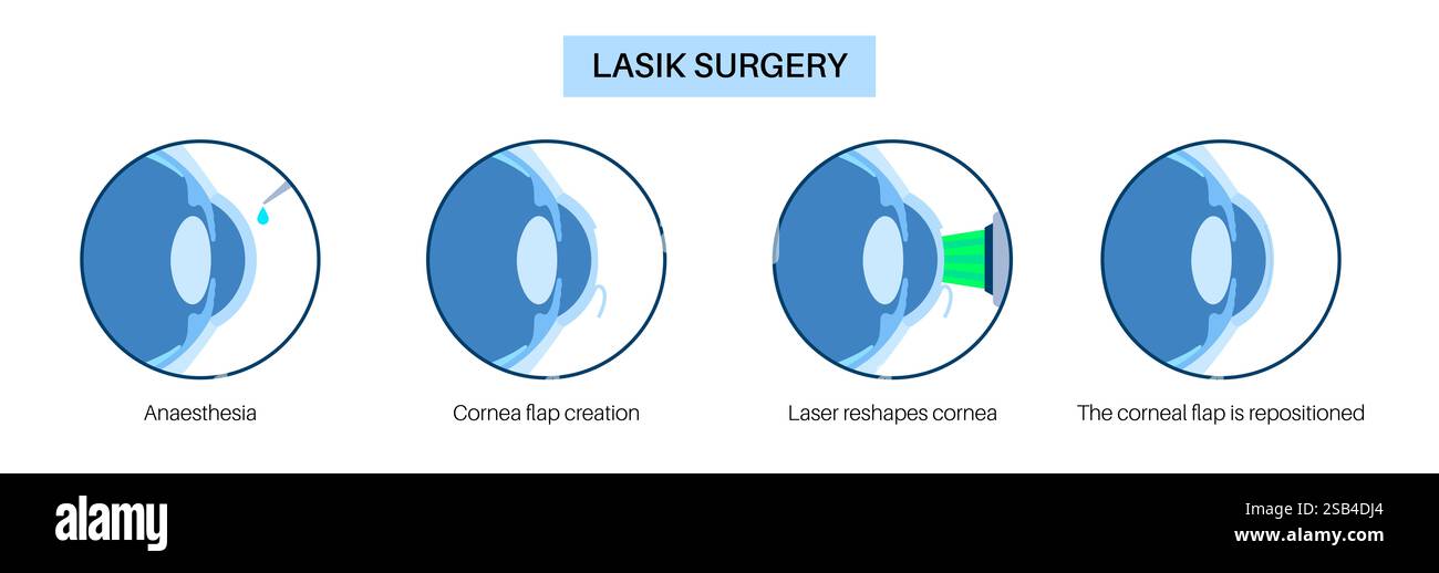Illustration of LASIK (Laser-Assisted In Situ Keratomileusis) also ...