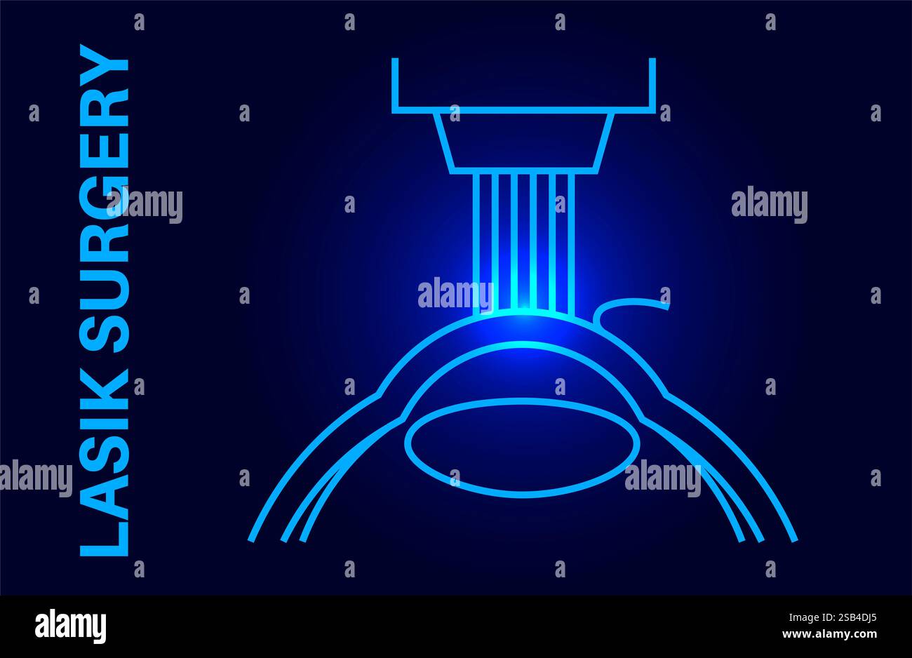 Illustration of LASIK (Laser-Assisted In Situ Keratomileusis) also ...