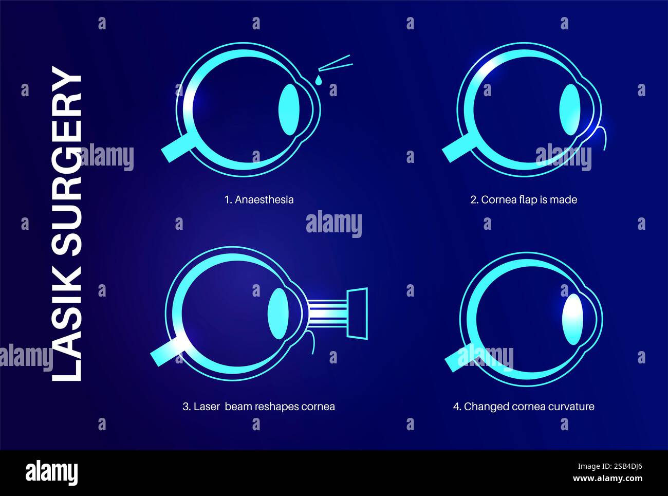 Illustration of LASIK (Laser-Assisted In Situ Keratomileusis) also ...