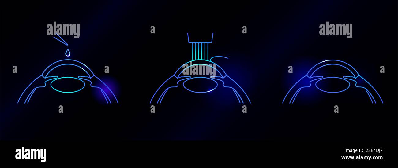 Illustration of LASIK (Laser-Assisted In Situ Keratomileusis) also ...