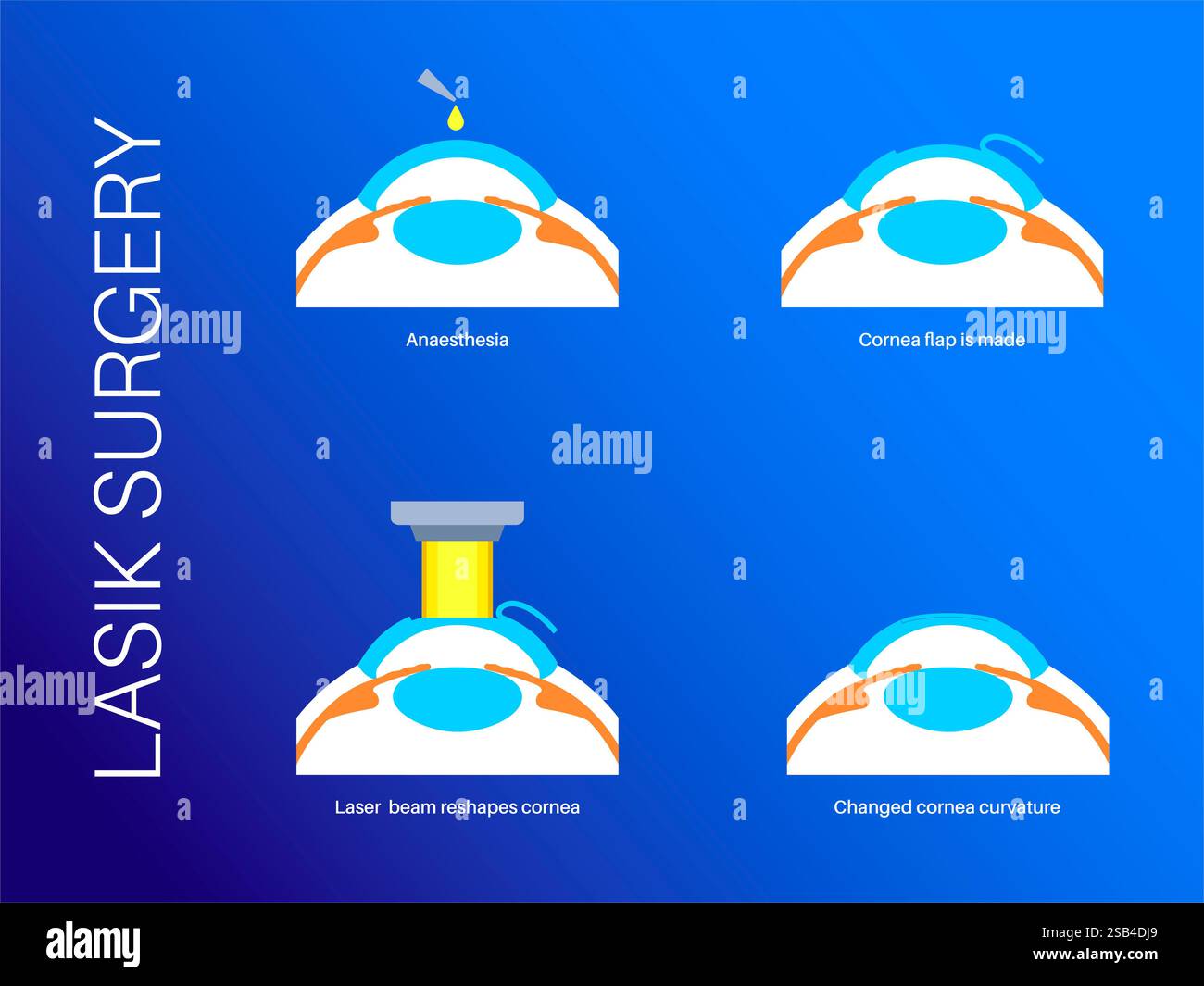 Illustration of LASIK (Laser-Assisted In Situ Keratomileusis) also ...