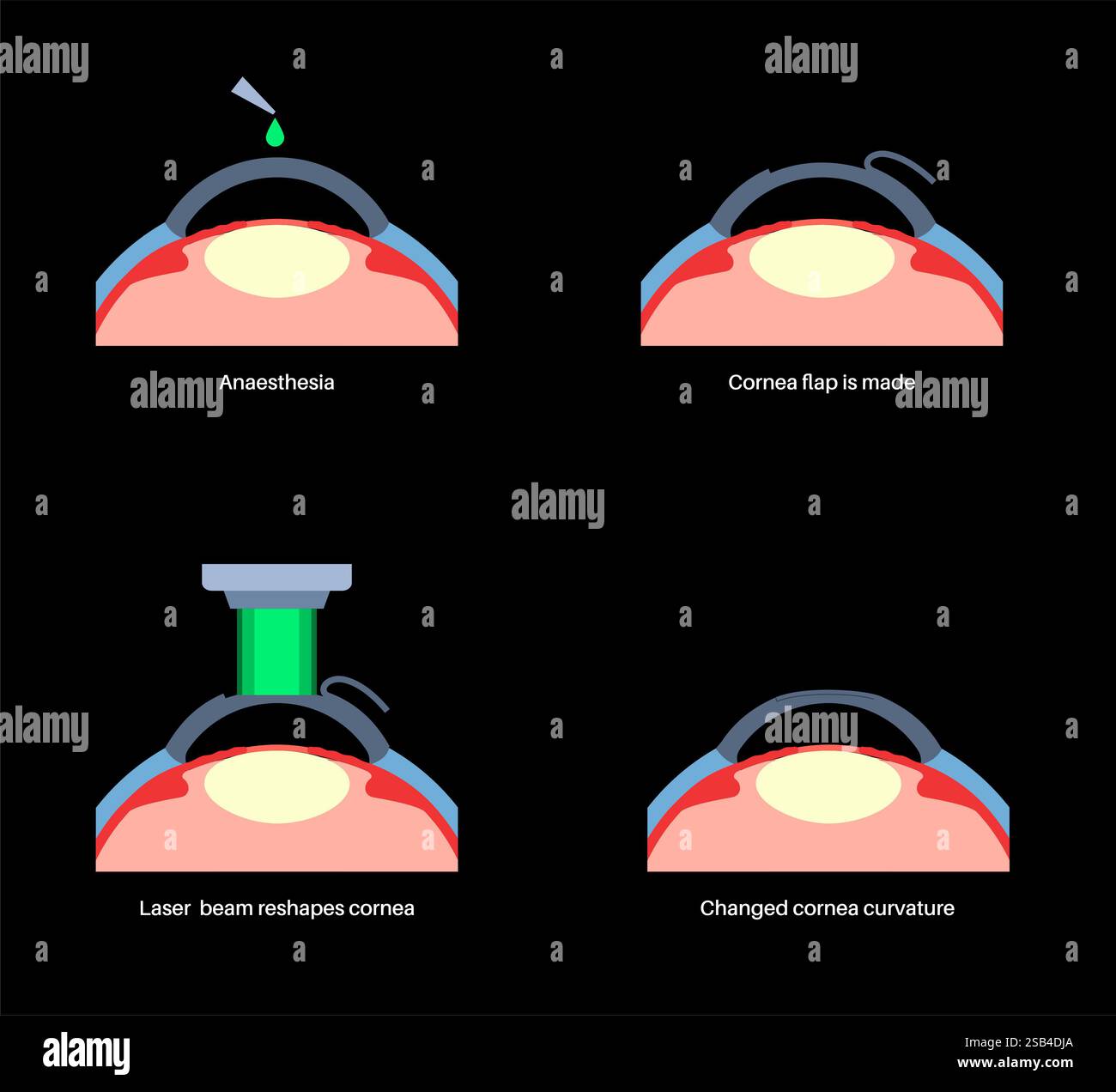 Illustration of LASIK (Laser-Assisted In Situ Keratomileusis) also ...