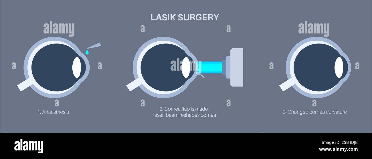Illustration of LASIK (Laser-Assisted In Situ Keratomileusis) also ...