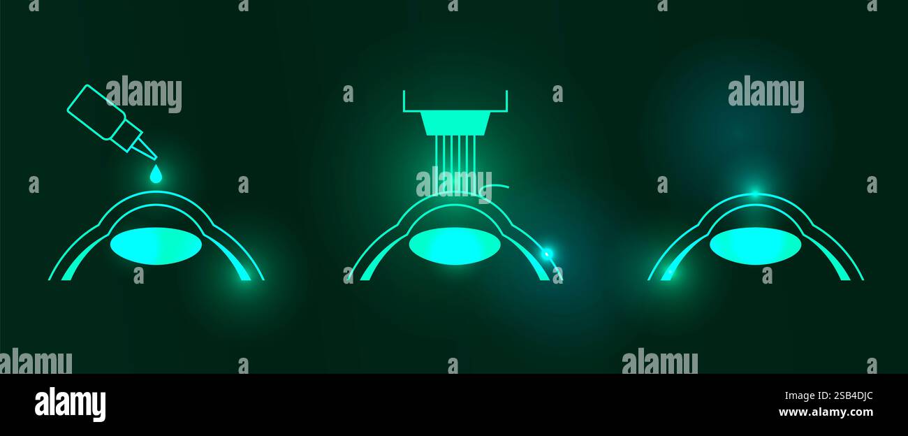 Illustration of LASIK (Laser-Assisted In Situ Keratomileusis) also ...