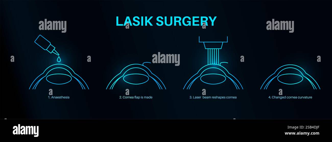 Illustration of LASIK (Laser-Assisted In Situ Keratomileusis) also ...