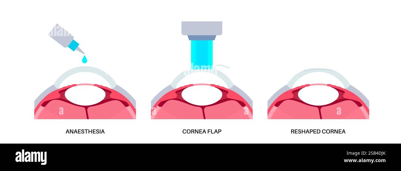 Illustration of LASIK (Laser-Assisted In Situ Keratomileusis) also ...