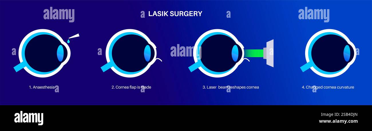 Illustration of LASIK (Laser-Assisted In Situ Keratomileusis) also ...