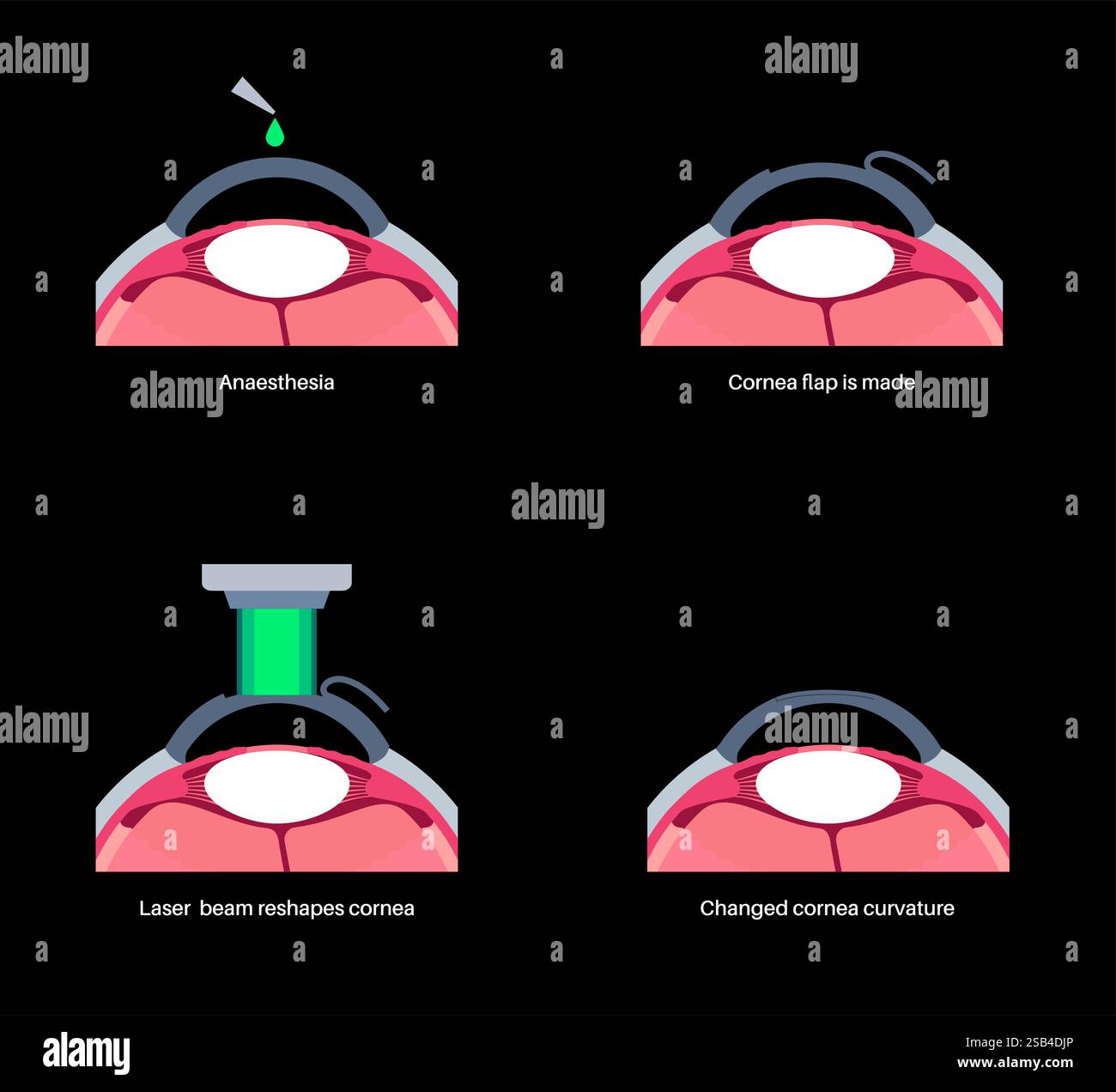 Illustration of LASIK (Laser-Assisted In Situ Keratomileusis) also ...