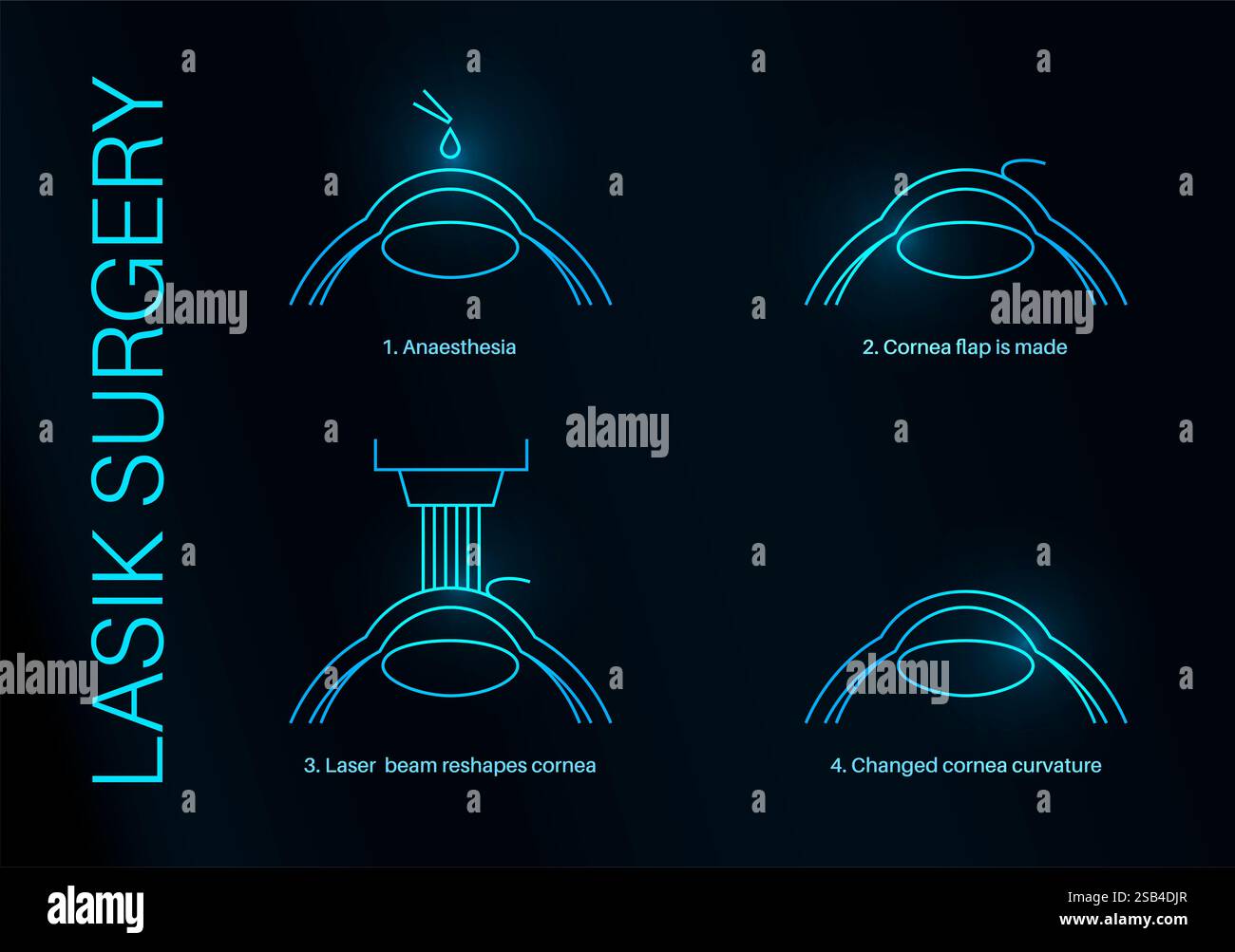 Illustration of LASIK (Laser-Assisted In Situ Keratomileusis) also ...