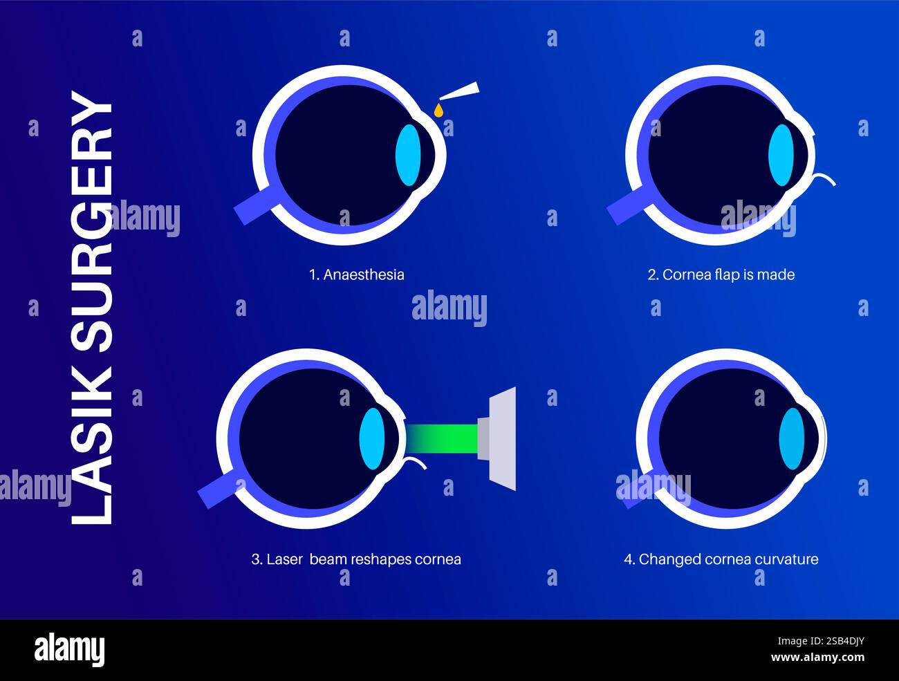 Illustration of LASIK (Laser-Assisted In Situ Keratomileusis) also known as laser eye surgery ...