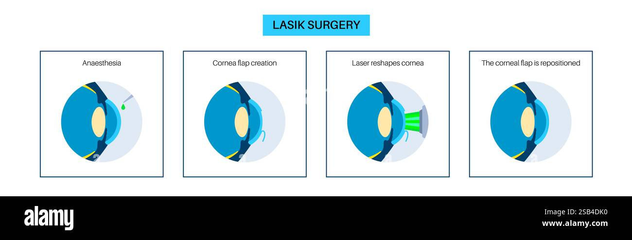 Illustration of LASIK (Laser-Assisted In Situ Keratomileusis) also ...