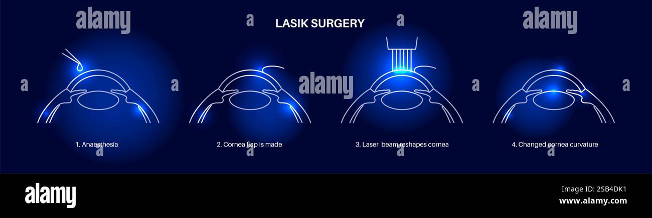 Illustration of LASIK (Laser-Assisted In Situ Keratomileusis) also ...