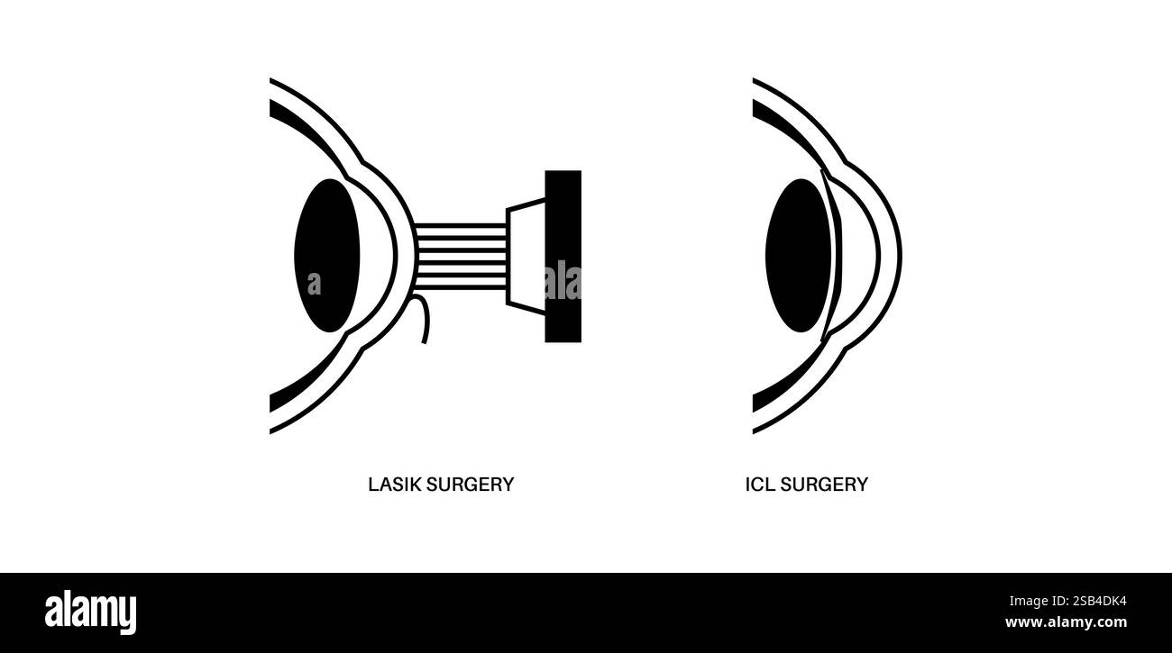 LASIK and EVO ICL eye surgery, illustration Stock Photo - Alamy