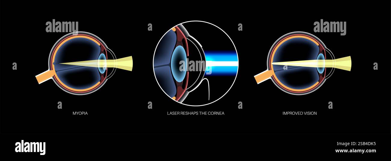 Illustration of laser eye surgery to correct myopia, also known as ...