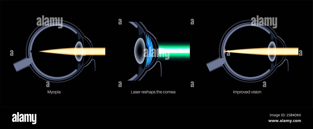 Illustration of laser eye surgery to correct myopia, also known as nearsightedness. The goal of ...