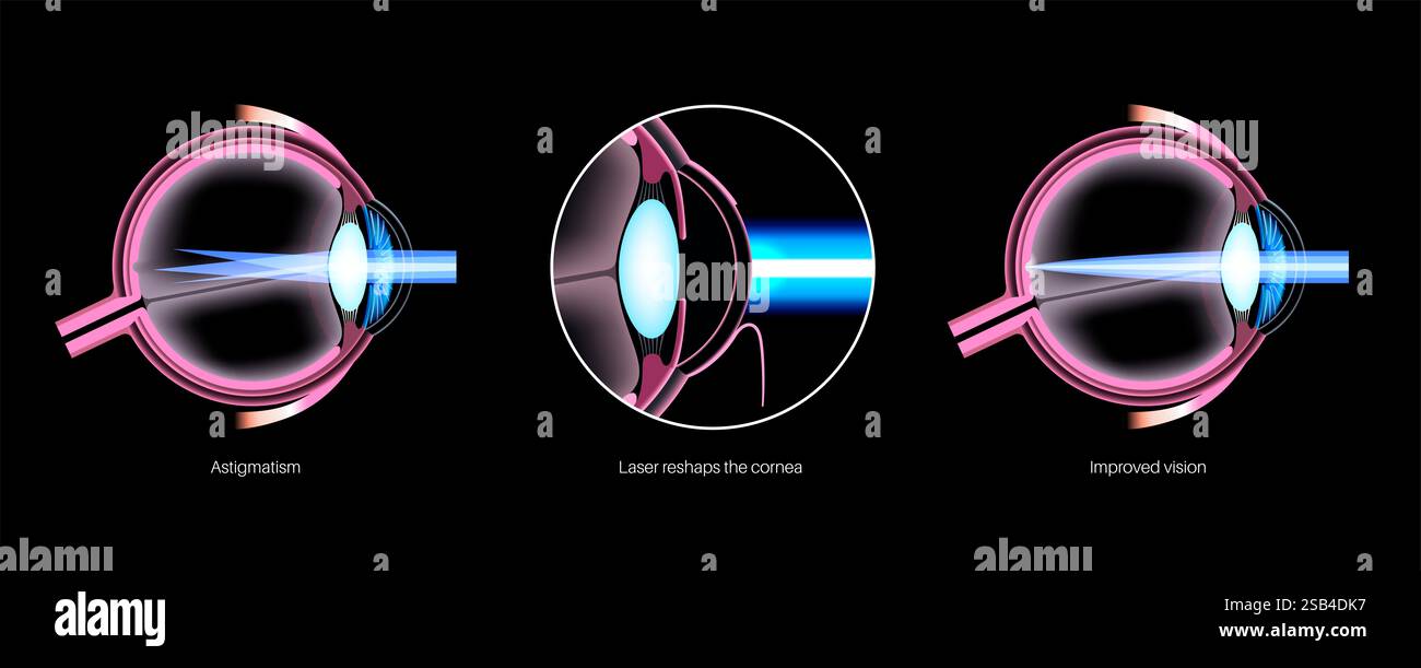 Illustration of laser eye surgery to correct astigmatism. Astigmatism ...