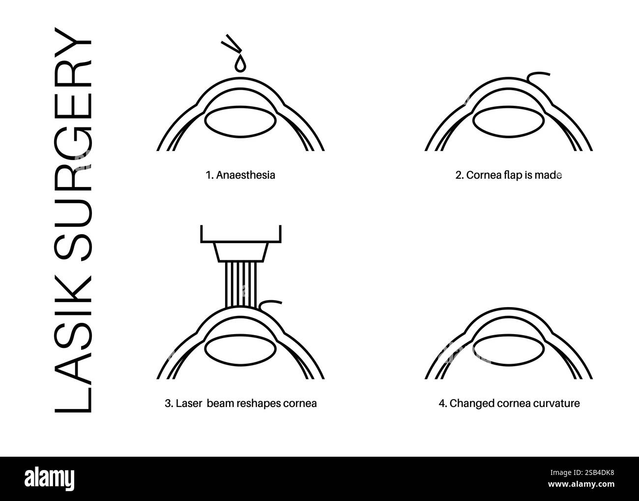 Illustration of LASIK (Laser-Assisted In Situ Keratomileusis) also ...
