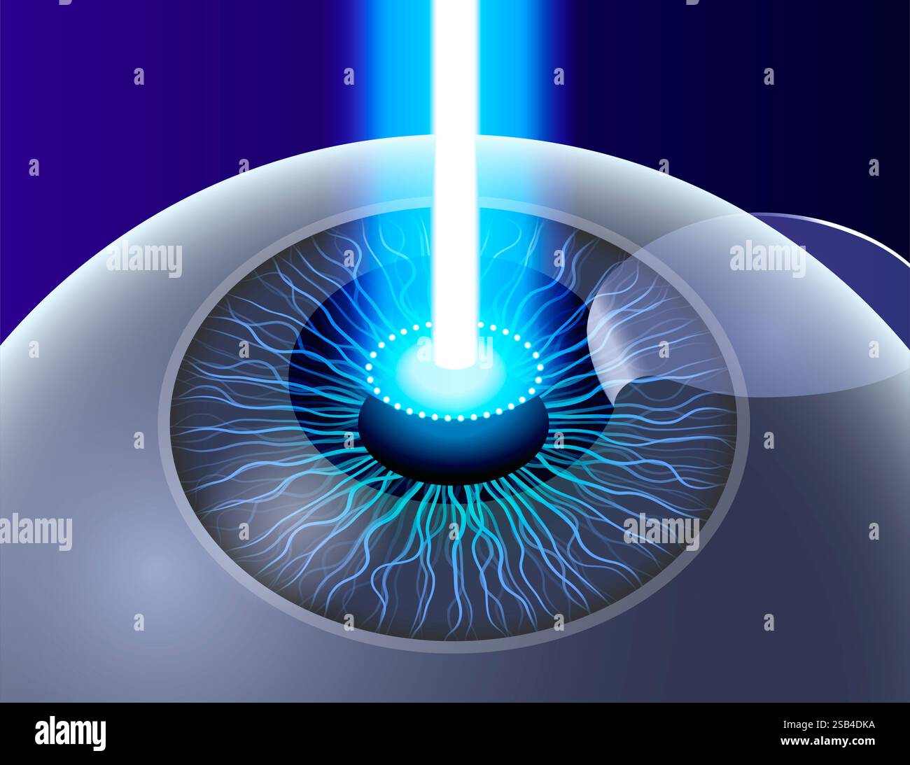 Illustration of LASIK (Laser-Assisted In Situ Keratomileusis) also ...