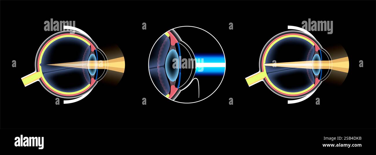 Illustration of laser eye surgery to correct myopia, also known as ...