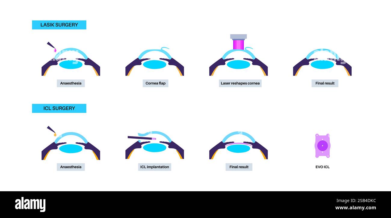 LASIK and EVO ICL eye surgery, illustration Stock Photo - Alamy