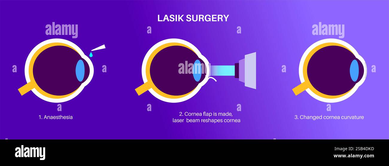 Illustration of LASIK (Laser-Assisted In Situ Keratomileusis) also ...