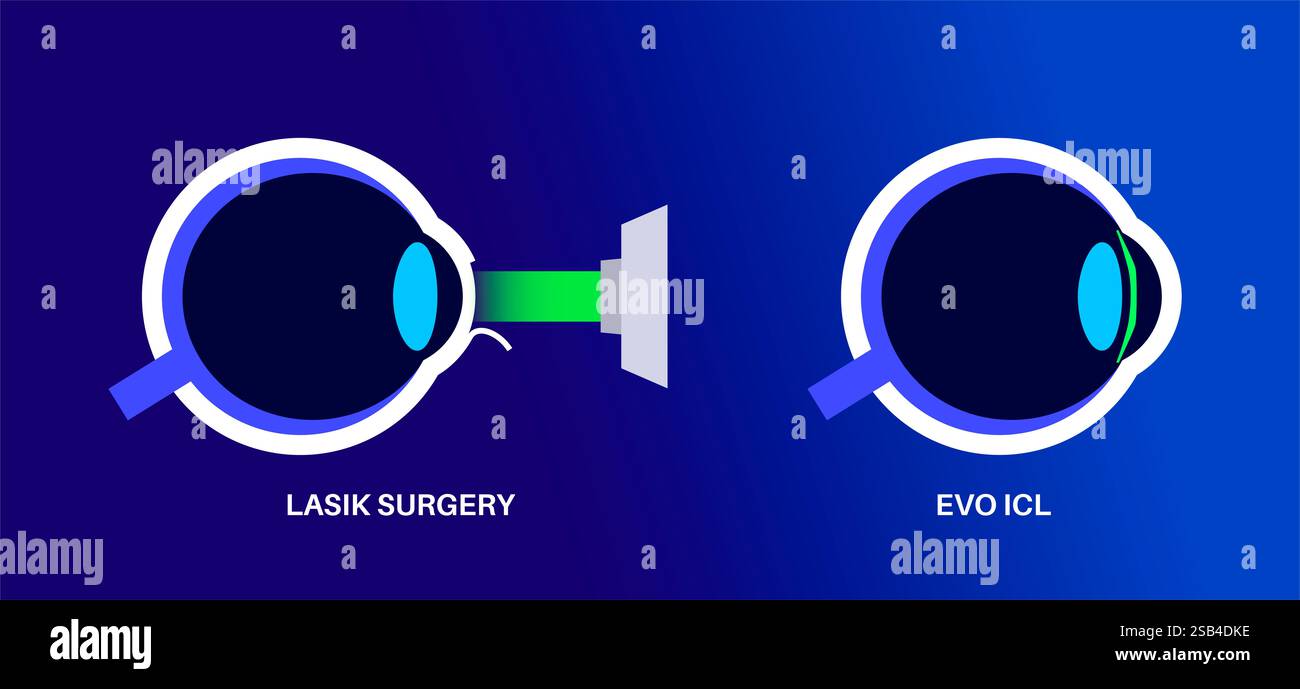 LASIK and EVO ICL eye surgery, illustration Stock Photo - Alamy