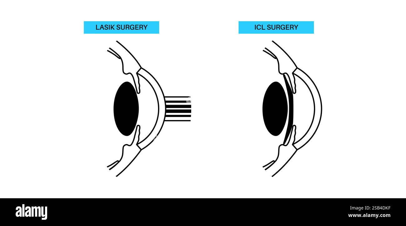 LASIK and EVO ICL eye surgery, illustration Stock Photo - Alamy