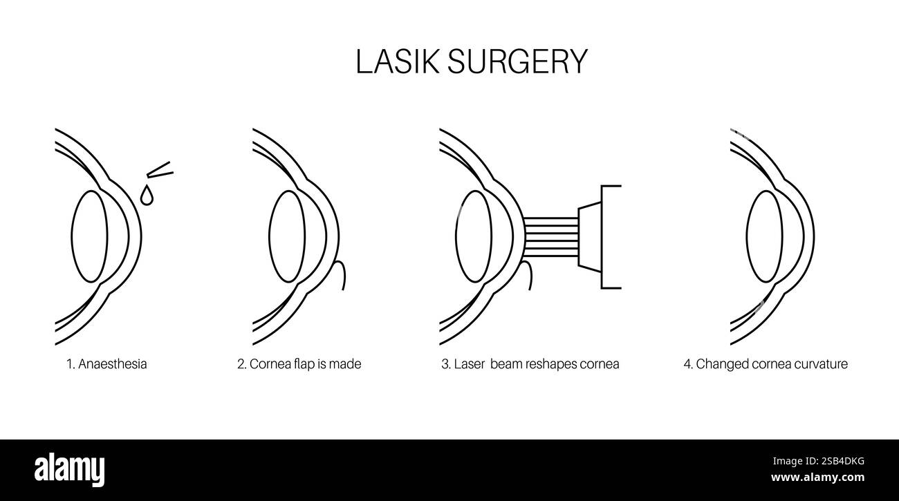 Illustration of LASIK (Laser-Assisted In Situ Keratomileusis) also ...