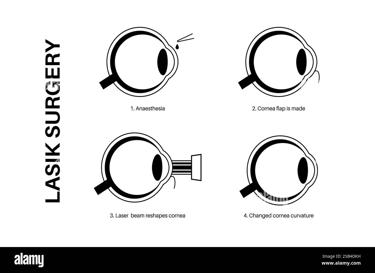 Illustration of LASIK (Laser-Assisted In Situ Keratomileusis) also ...