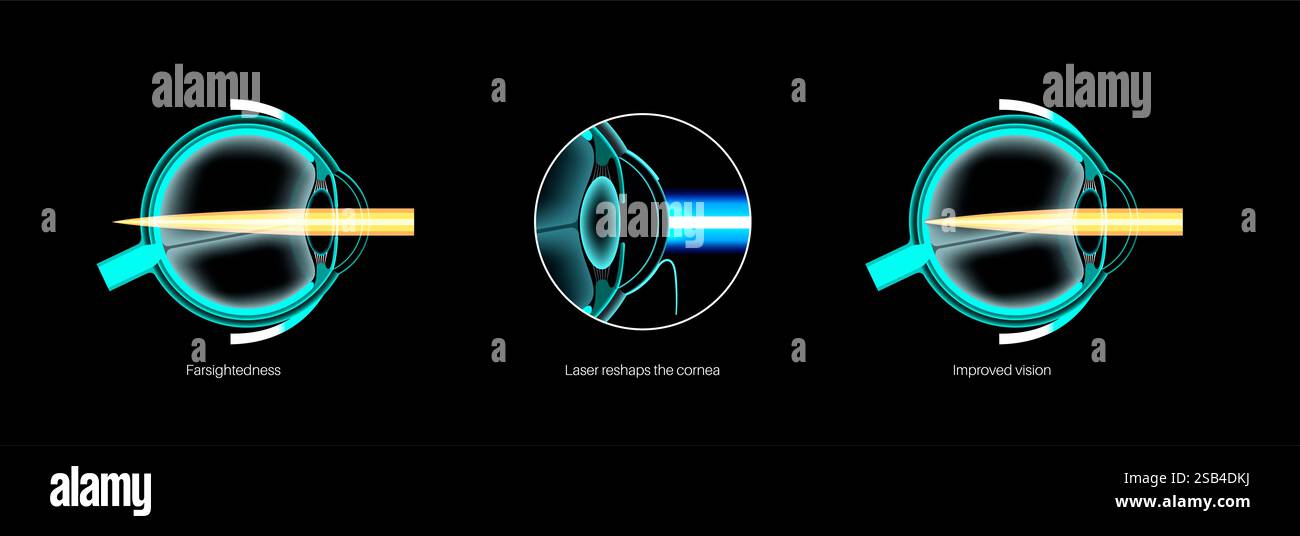 Illustration of laser eye surgery to correct hyperopia, also known as ...