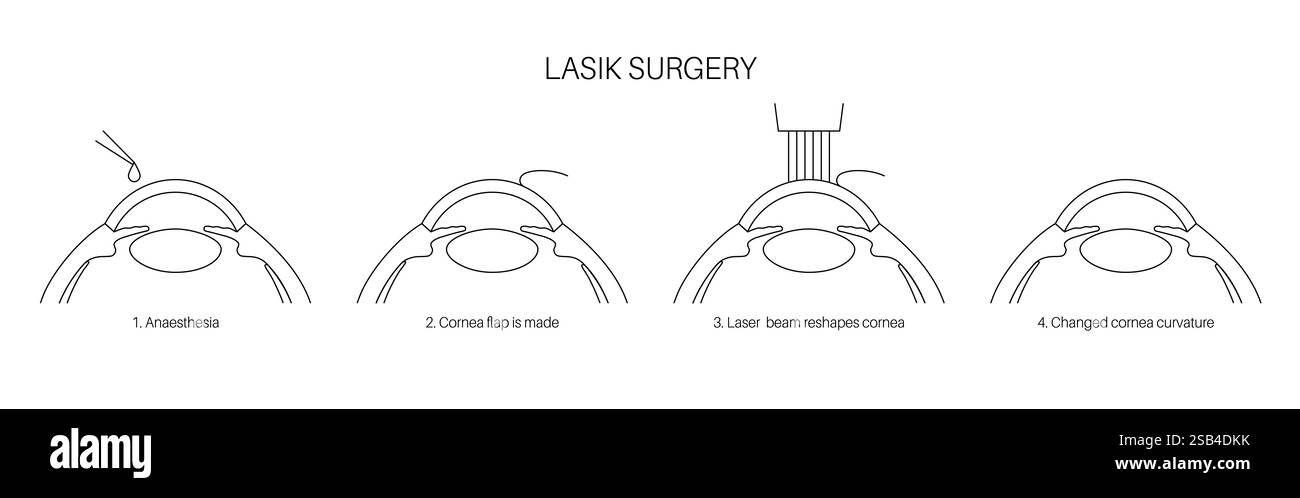 Illustration of LASIK (Laser-Assisted In Situ Keratomileusis) also ...