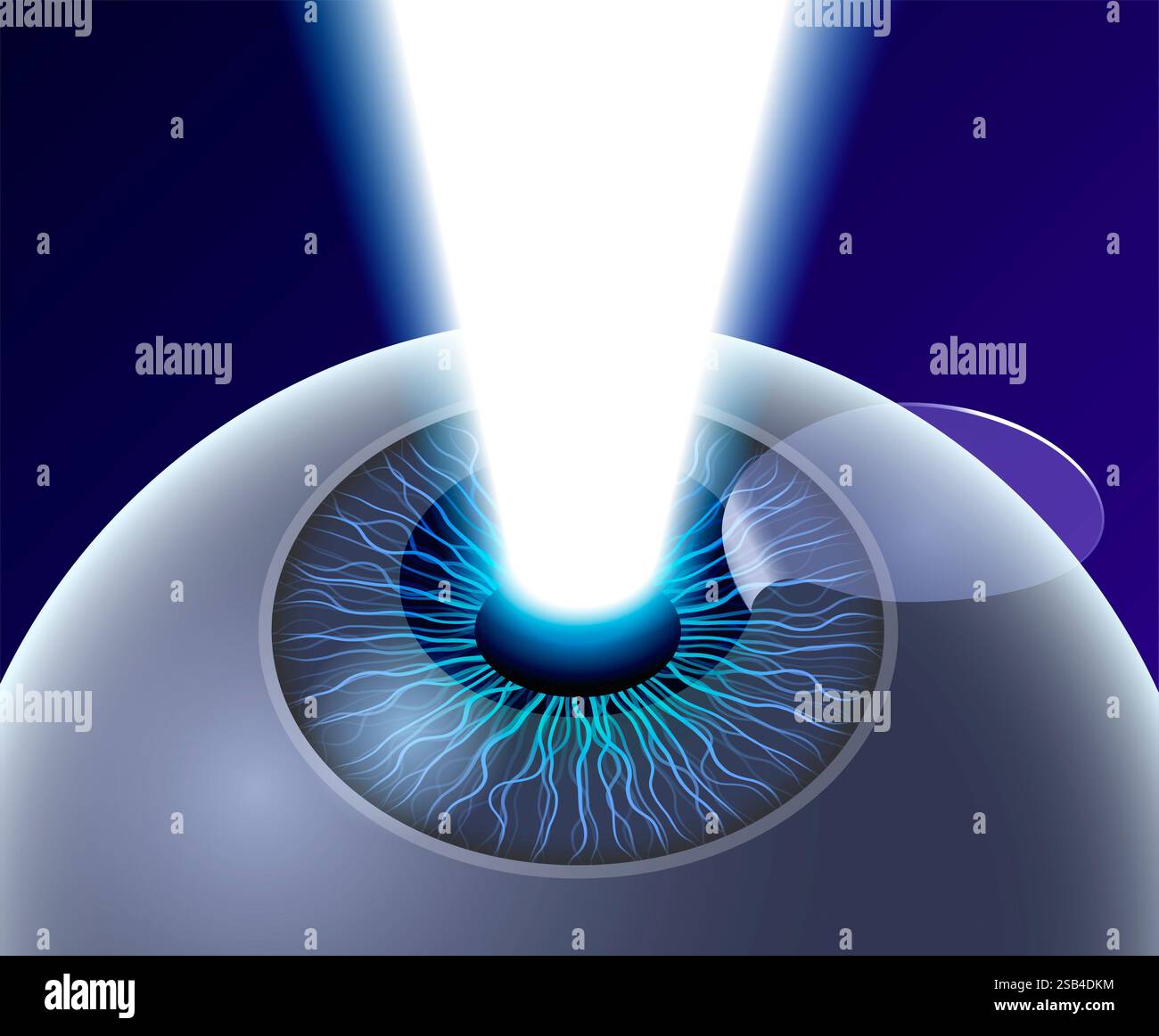 Illustration of LASIK (Laser-Assisted In Situ Keratomileusis) also ...