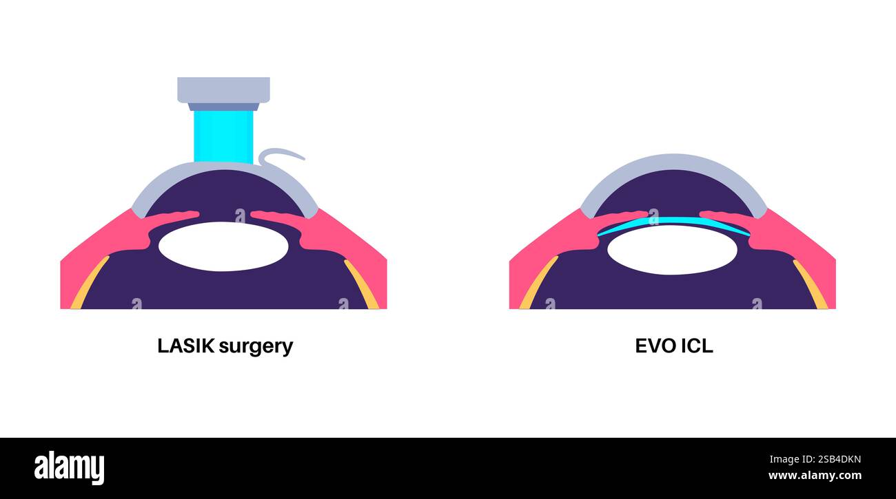 LASIK and EVO ICL eye surgery, illustration Stock Photo - Alamy