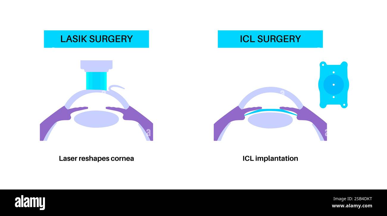 LASIK and EVO ICL eye surgery, illustration Stock Photo - Alamy