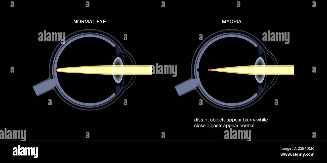 Illustration of a normal eye and an eye with nearsightedness ...